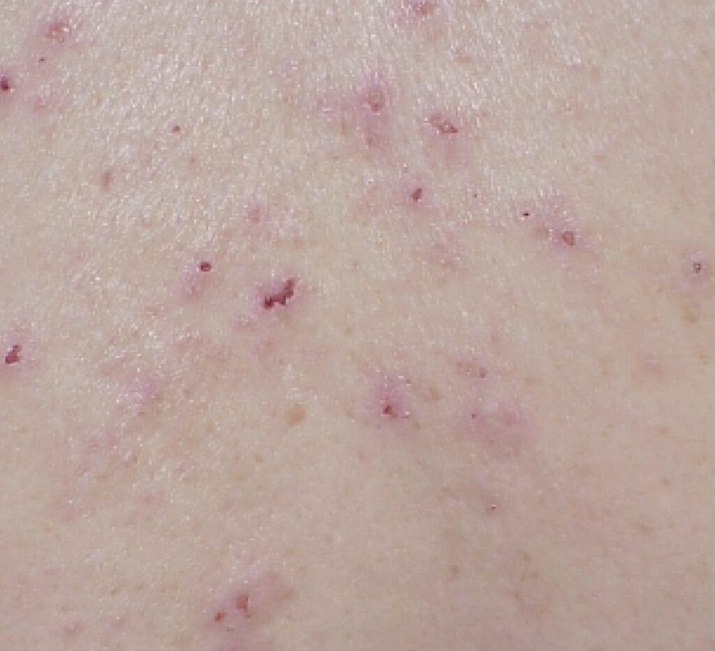 Dermatitis Herpetiformis Symptoms & Testing | BeyondCeliac.org